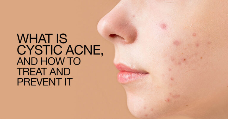 Cystic Acne - What is and how to treat it? | DrGL